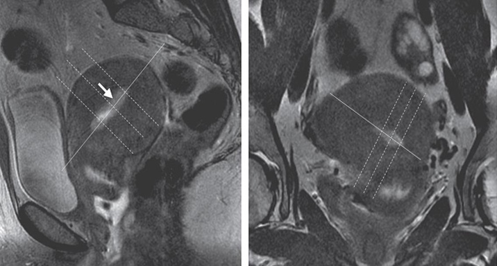 MR Female Pelvis for Uterine Cancer Staging WWO BODY Protocol | OHSU